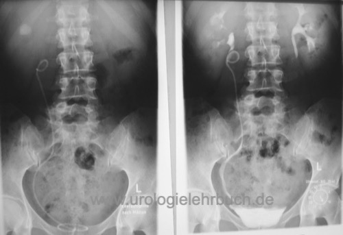 Urogramm (Ausscheidungsurographie): Kontrastmittel-Röntgen der Niere ...